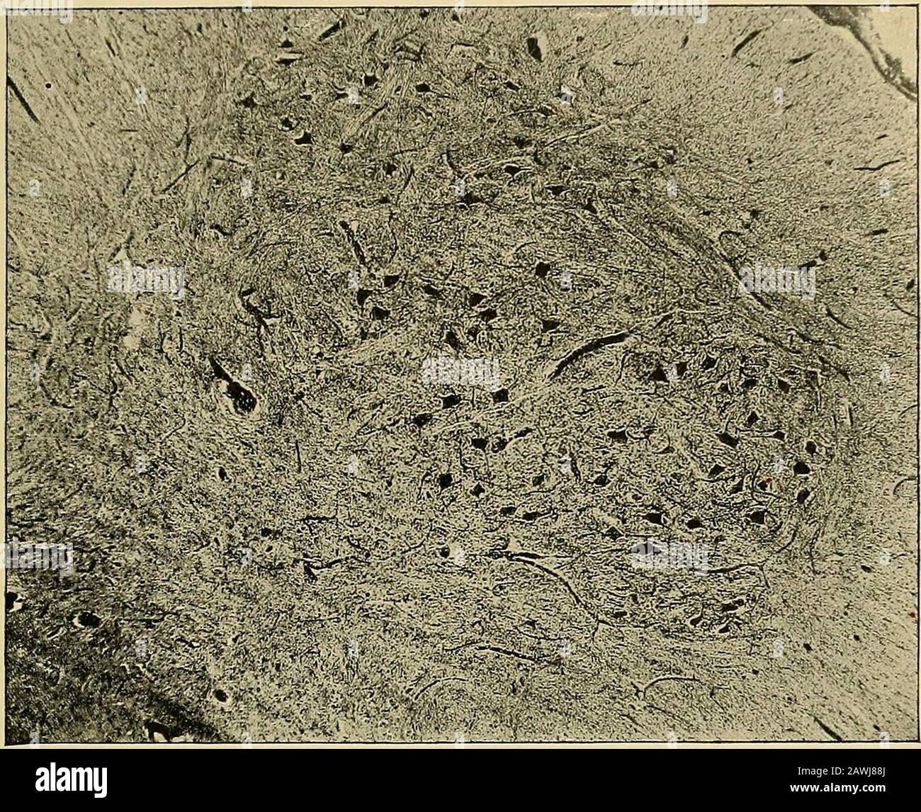 Intrinsic muscles of foot hi-res stock photography and images - Alamy