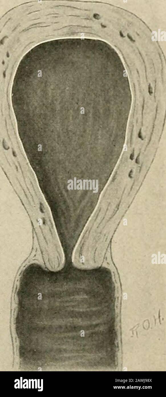 Rectal tenesmus hi-res stock photography and images - Alamy