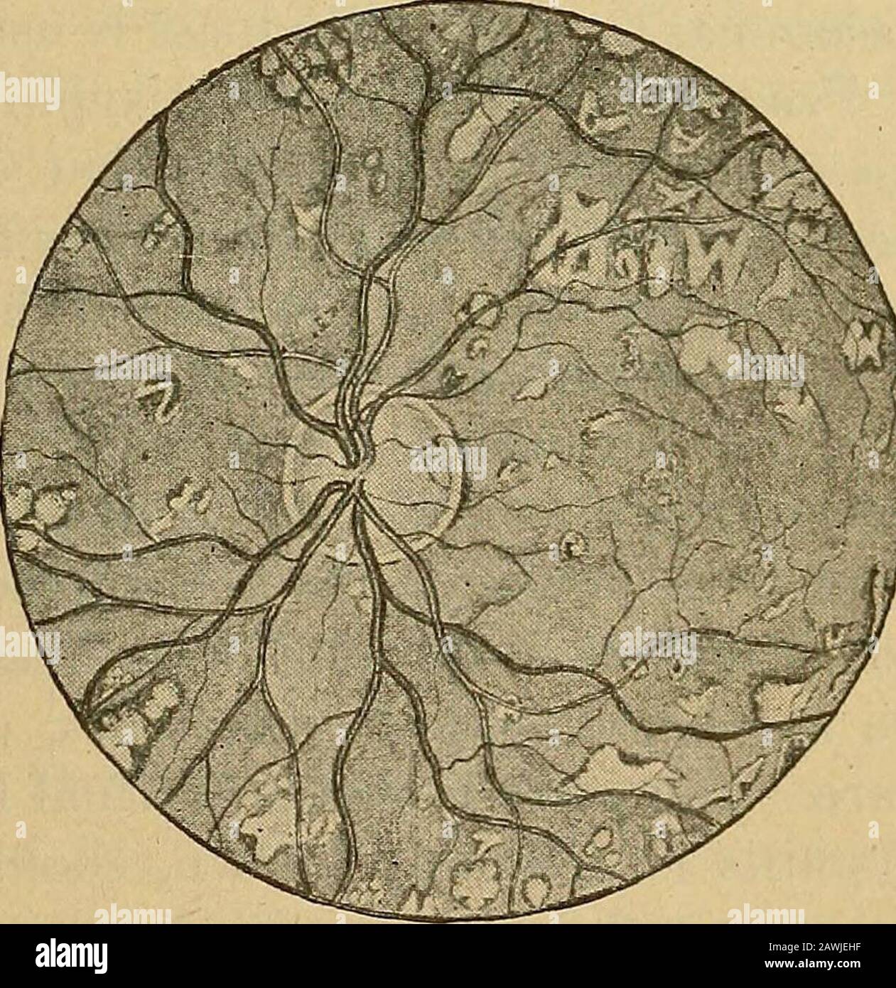 Manual of ophthalmology . ation, nu-merous round, oval, and ir-regular ...