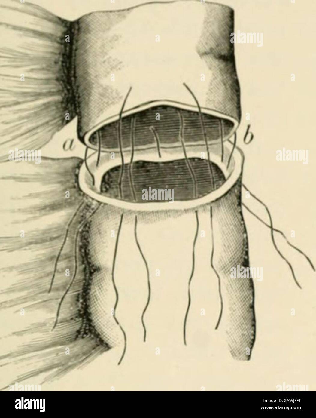 Proximal attachment hi-res stock photography and images - Alamy
