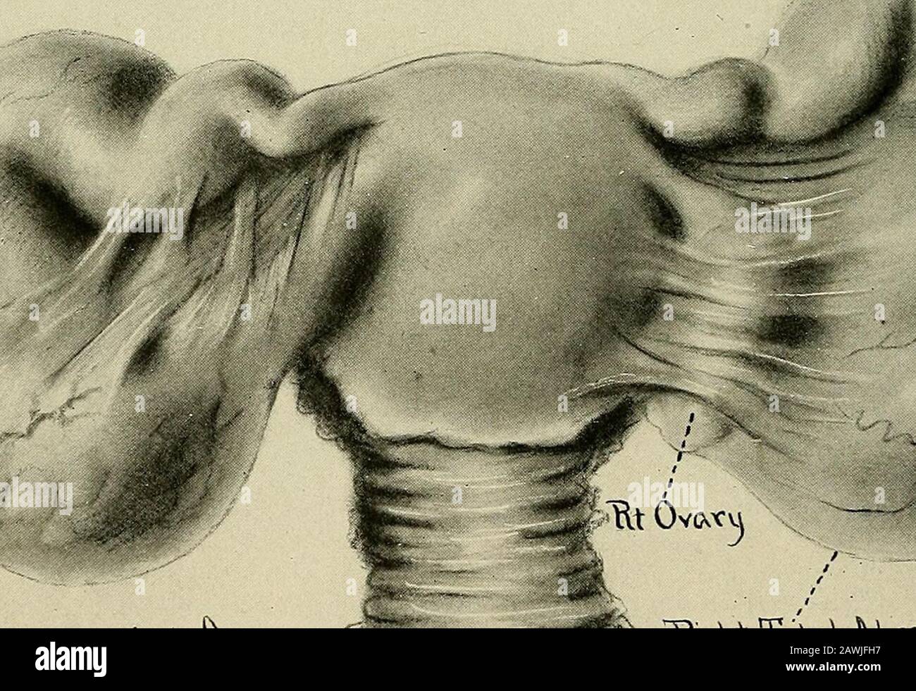 Gynecology . WVoaeo hnb- Fig. 36.—Tubo-ovaritis. Diagram showing how an ...