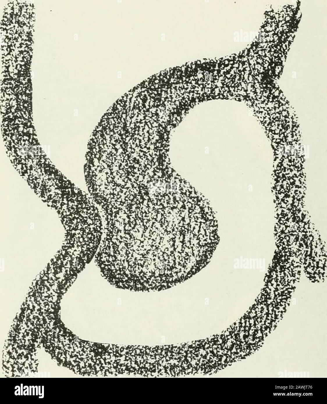 Turbinate hypertrophy hi-res stock photography and images - Alamy