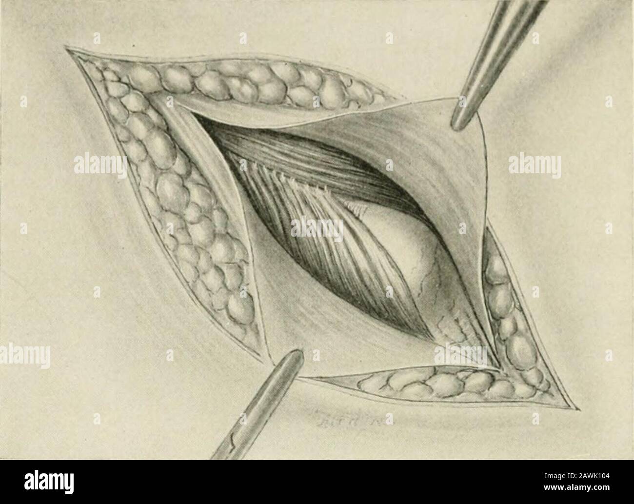 Abdominal adhesions hi-res stock photography and images - Alamy