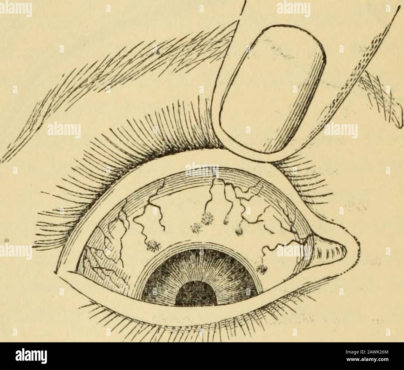 The student's guide to diseases of the eye . Fig. 22.—Conjunctival ...