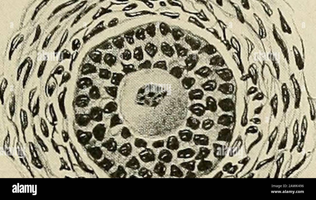 Gynecology . Fig. 10.—Graafian Follicle.High power. Three follicles are ...