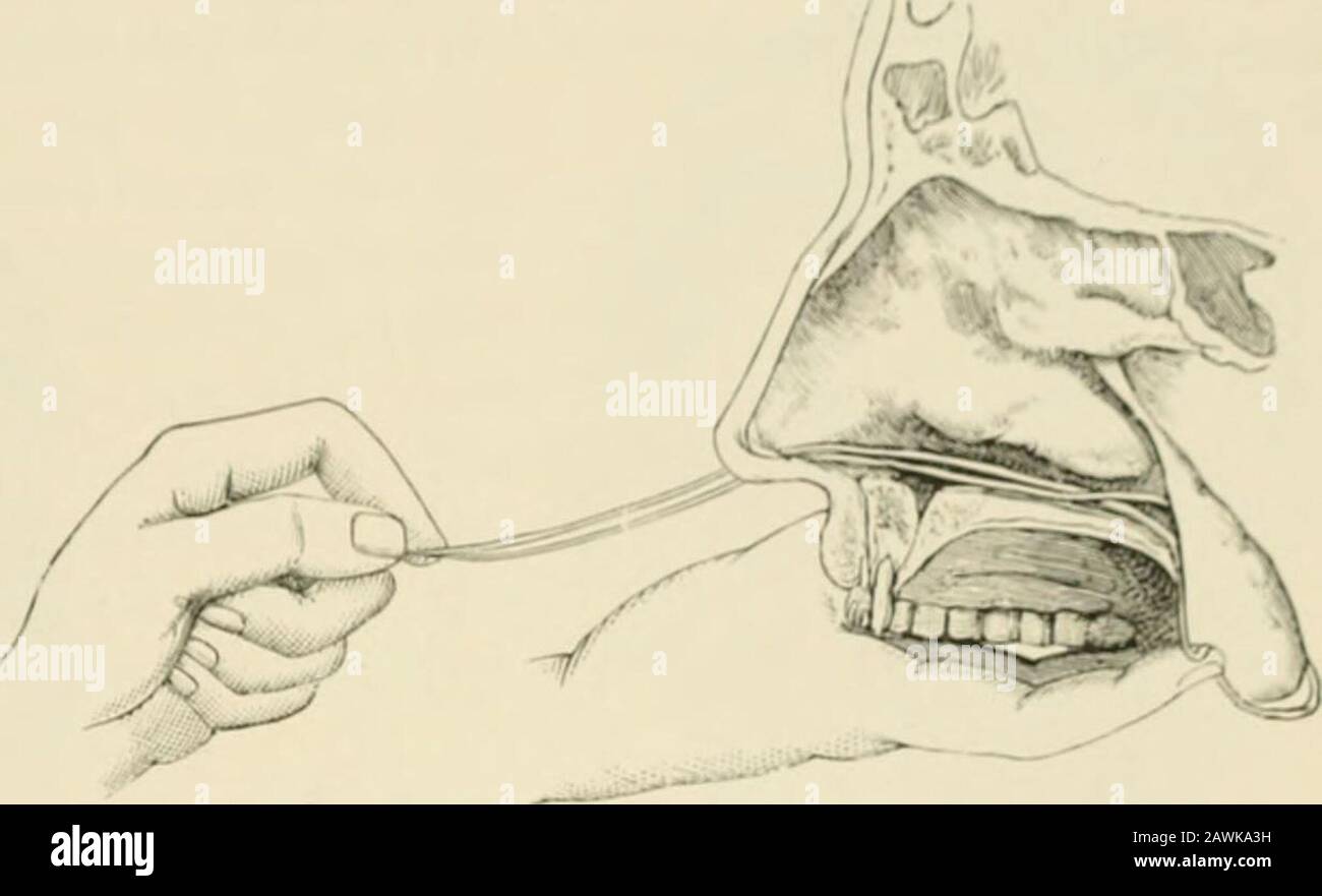 Operative surgery . EiG. 747.—Implements eraploved in plugging nares ...