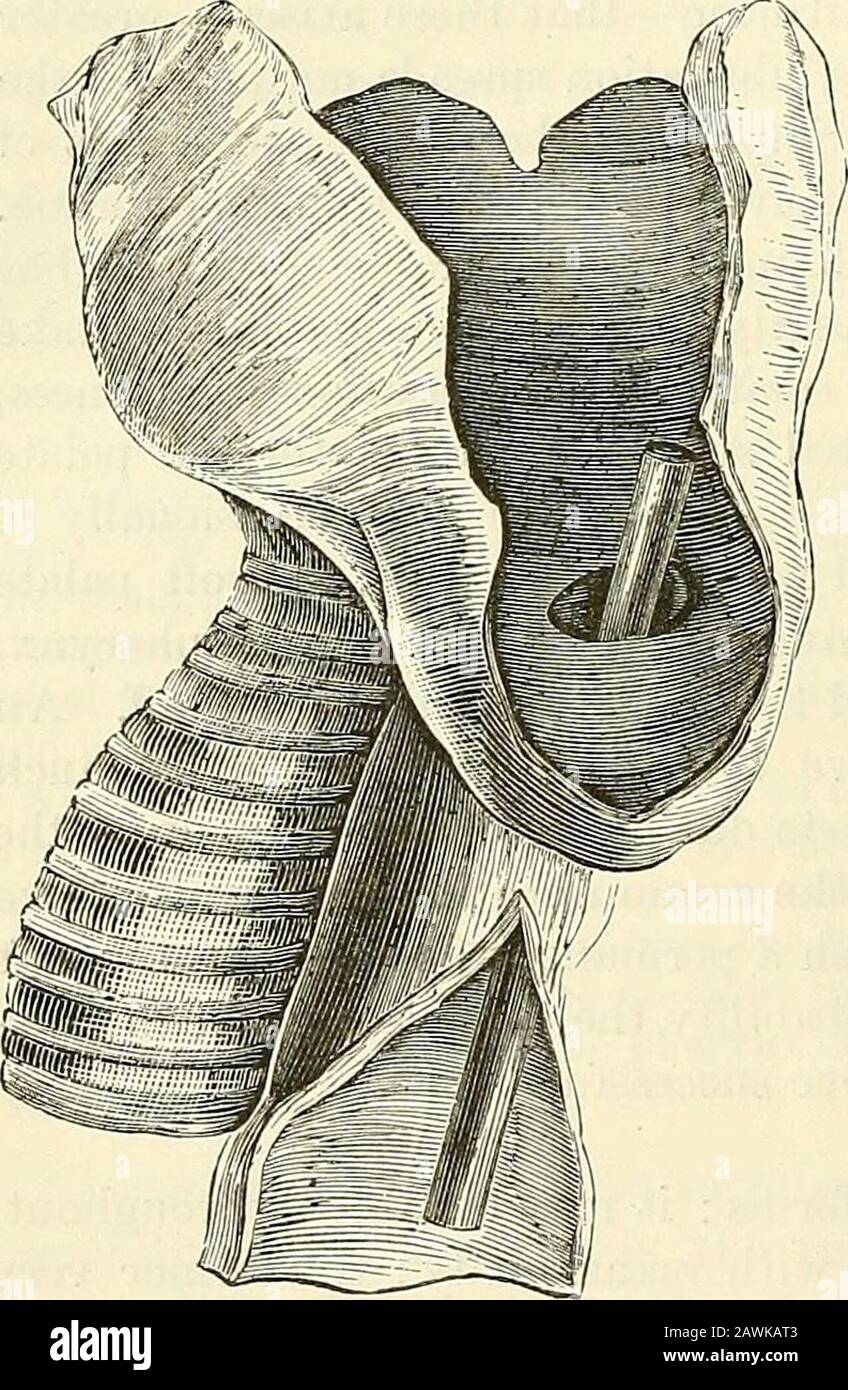 A system of surgery : theoretical and practical . be a large, pendulous ...