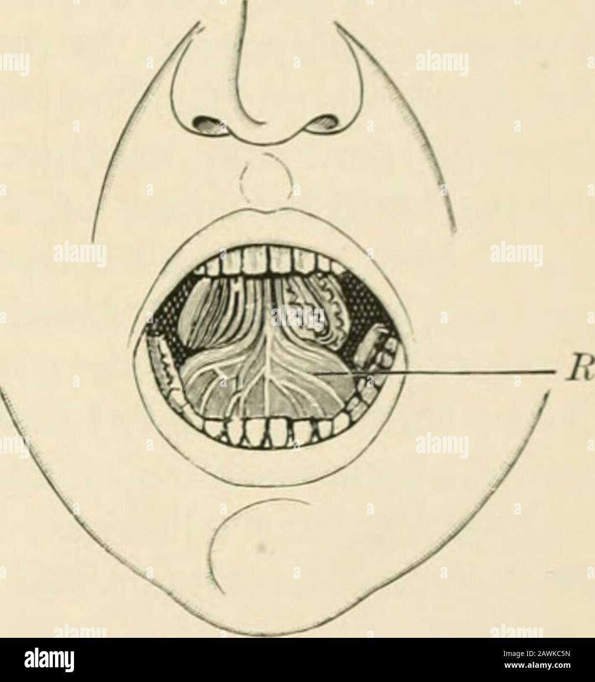 Pharyngotomy hi-res stock photography and images - Alamy