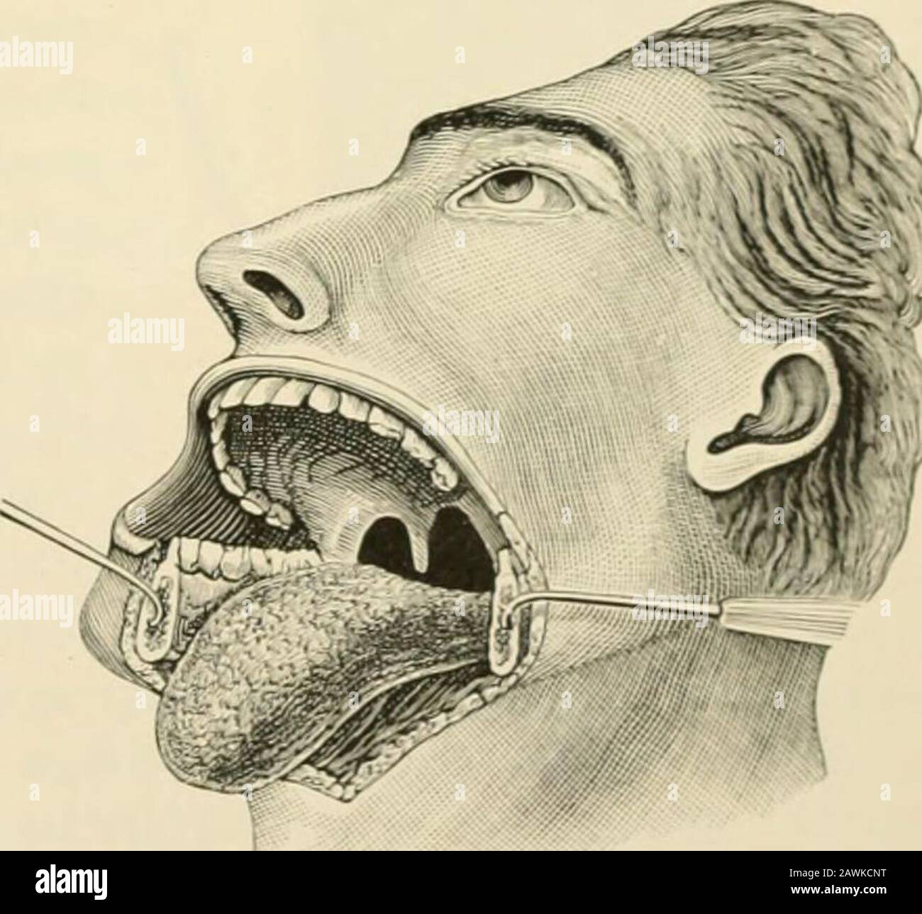 Operative surgery . Fig. 741.—Tongue exposed tliroughBiUroths submental ...