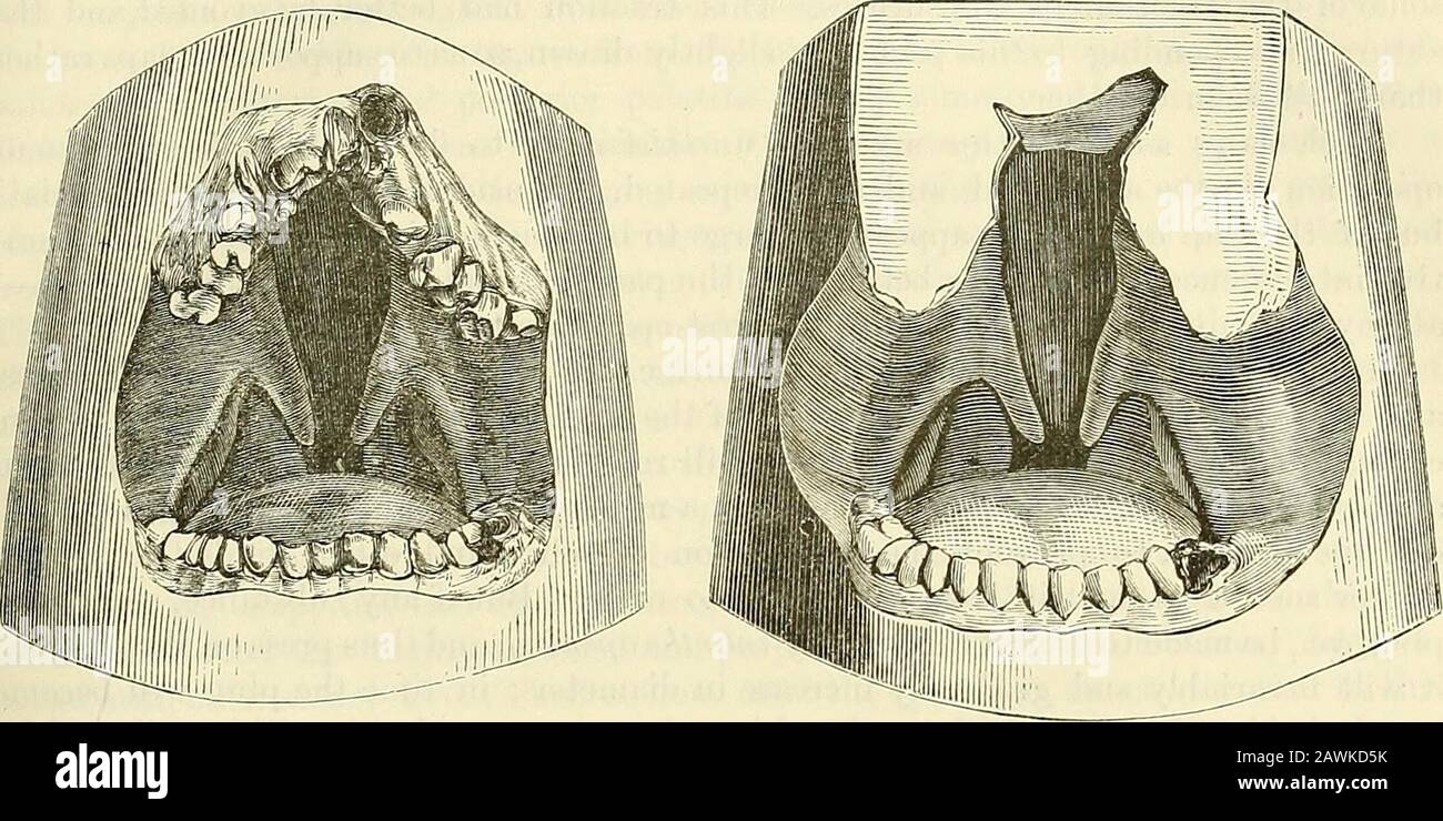 A system of surgery : theoretical and practical . o remove them under ...