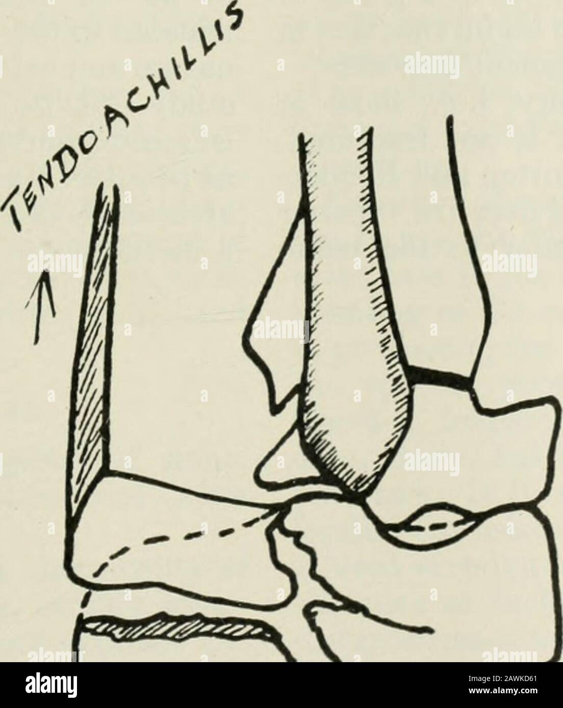 Impacted fracture hi-res stock photography and images - Alamy