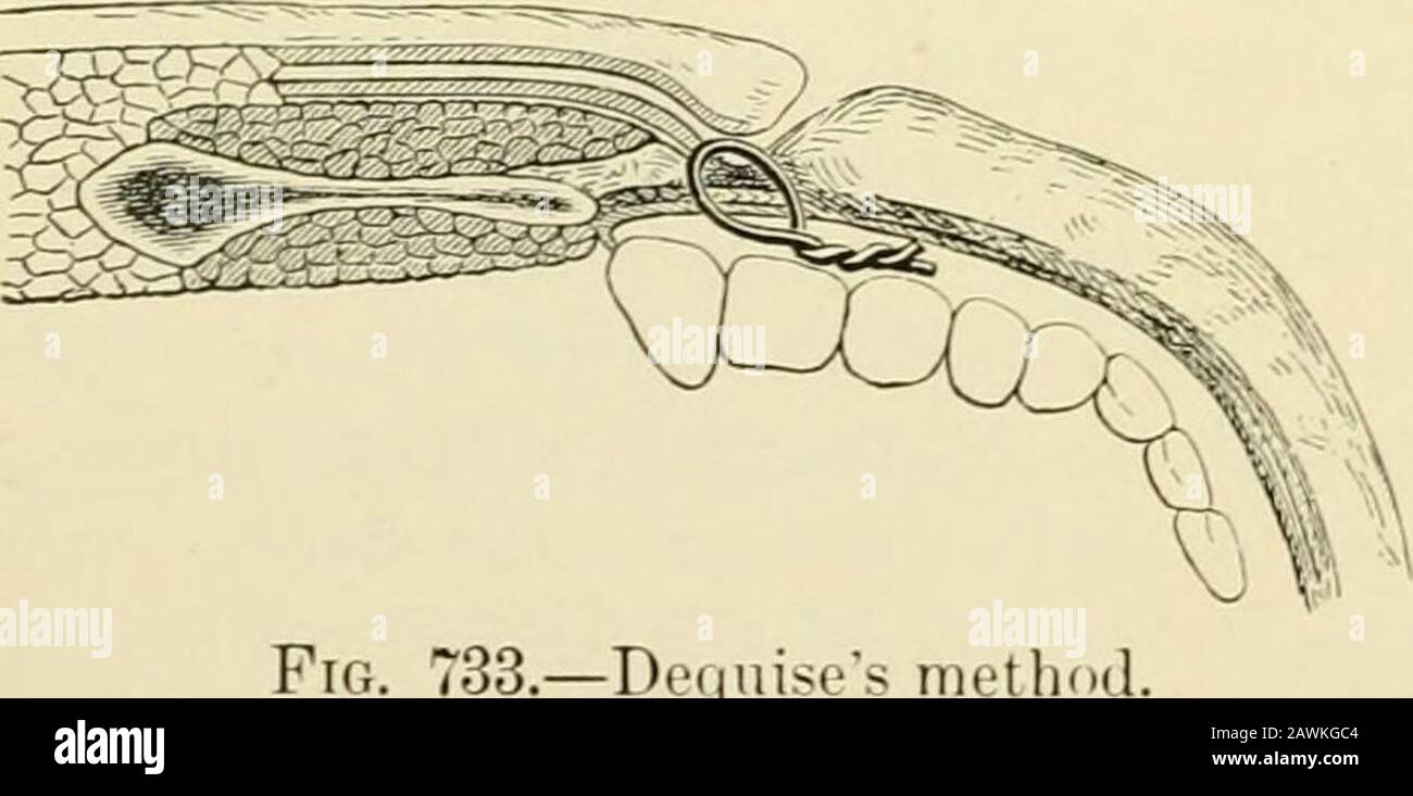 Tonsil operation hi-res stock photography and images - Alamy