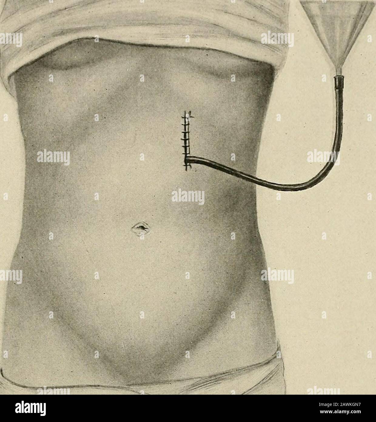 Gastrostomy hi-res stock photography and images - Alamy