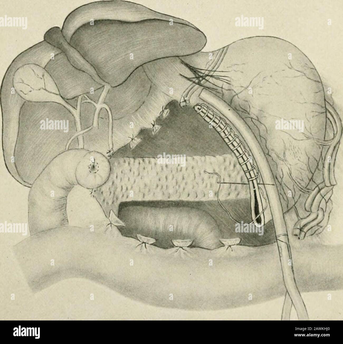 Transverse mesocolon hi-res stock photography and images - Alamy