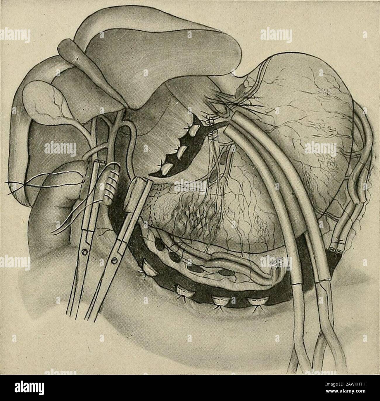 Total gastrectomy hi-res stock photography and images - Alamy