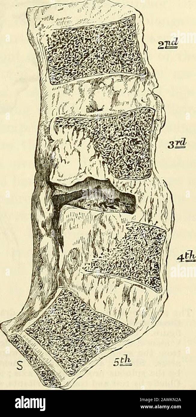 A system of surgery : theoretical and practical . taneous gummata, as ...