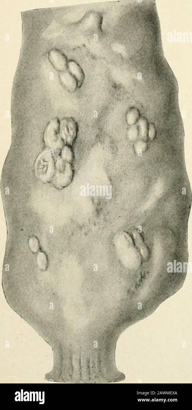 Rectal tenesmus hi-res stock photography and images - Alamy
