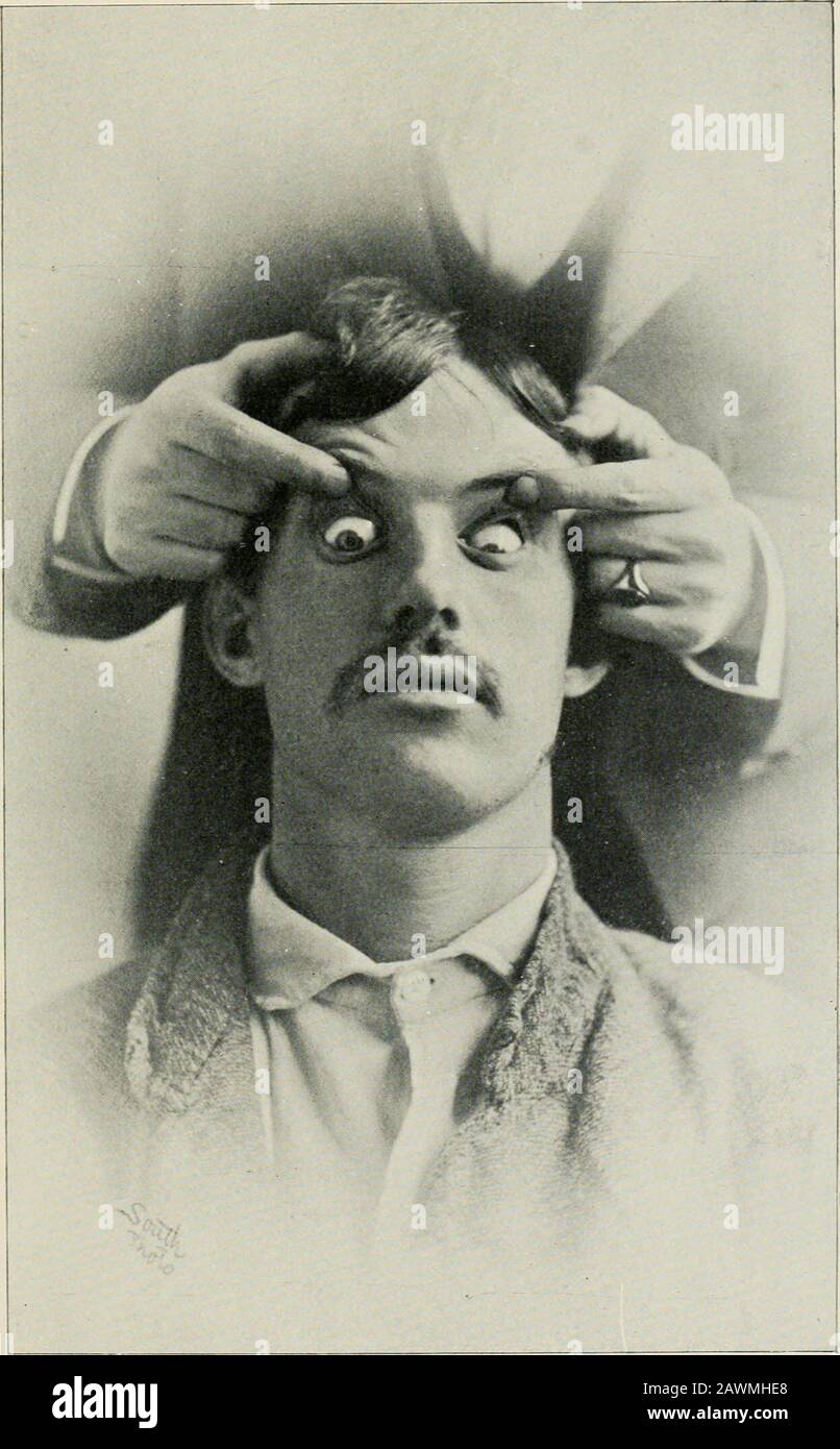 Exophthalmos hi-res stock photography and images - Alamy