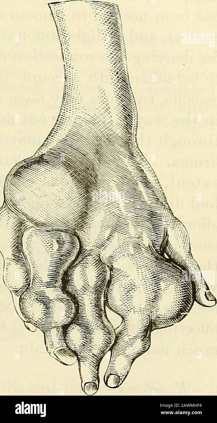 A system of surgery : theoretical and practical . ossify in the strict ...