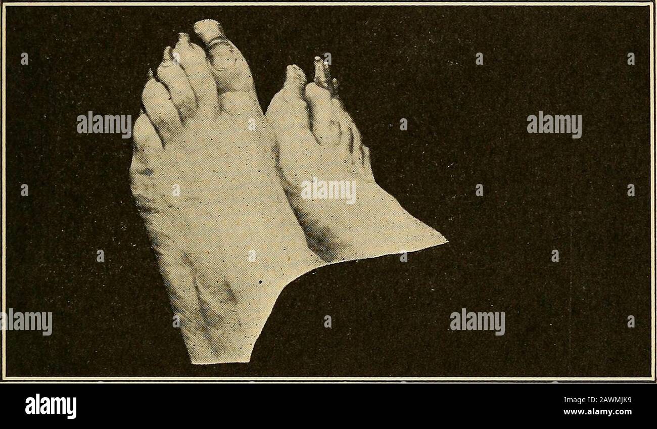 Thickening of the nail hi-res stock photography and images - Alamy