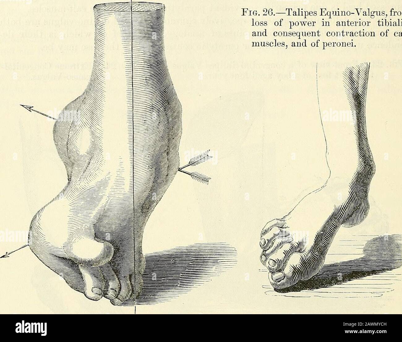 Tenotomy hi-res stock photography and images - Alamy