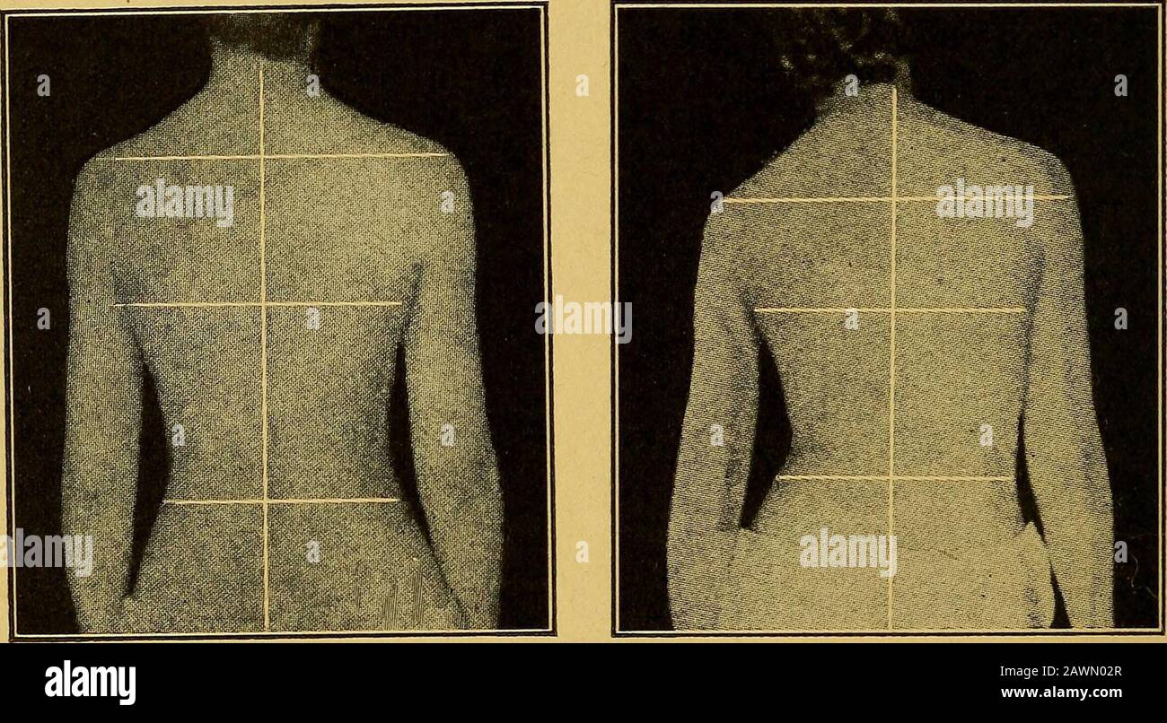 Scoliosis brace hi-res stock photography and images - Alamy