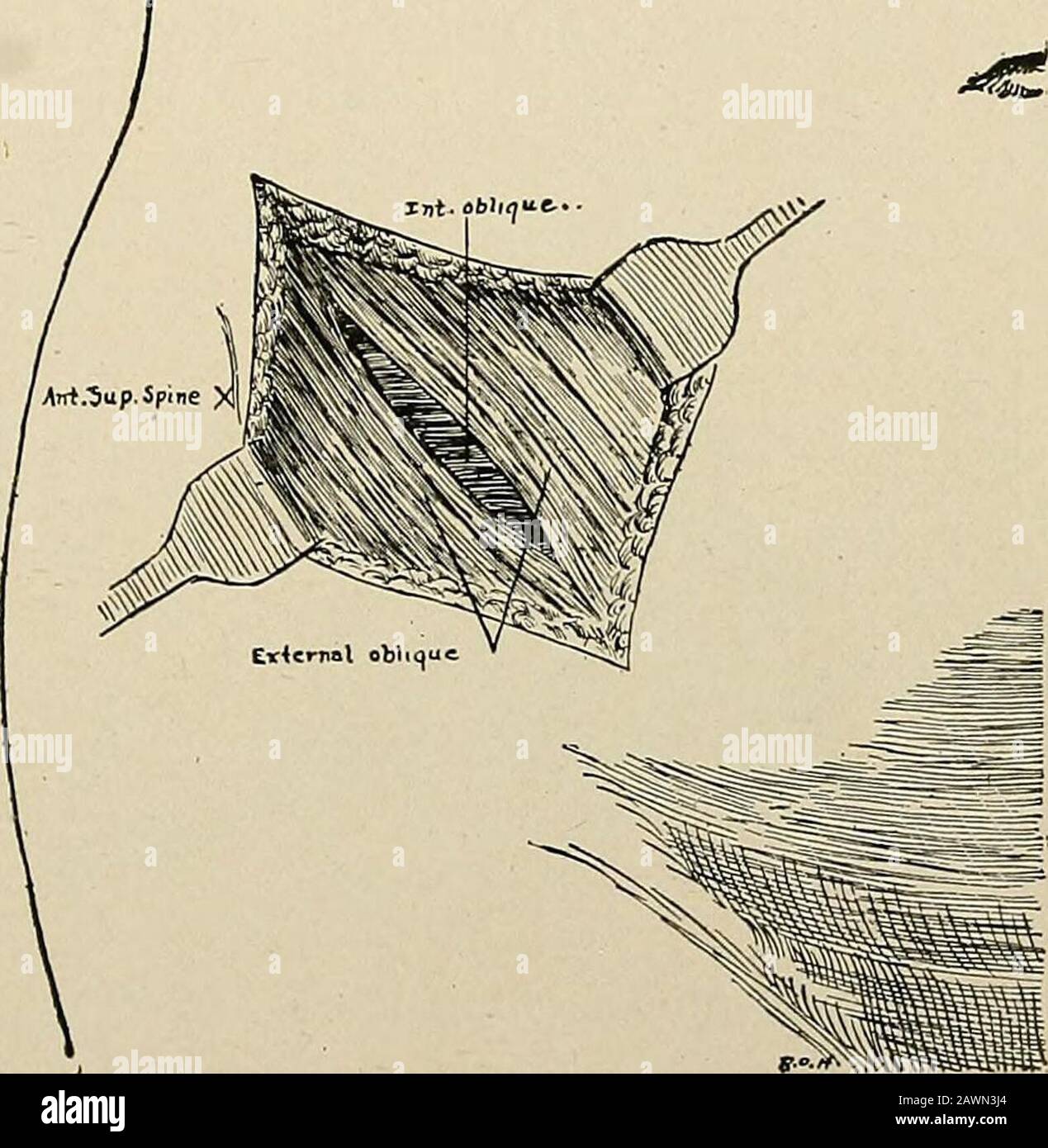 The practice of surgery . A-S4. X 1 TRAriSVCKifiLtd Fig. 8.—McBurneys ...