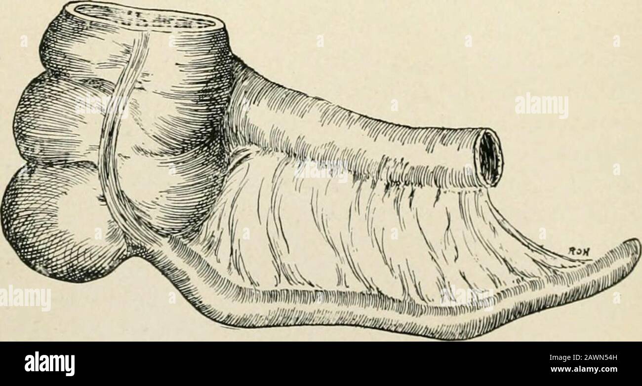Vermiform Appendix Arise From