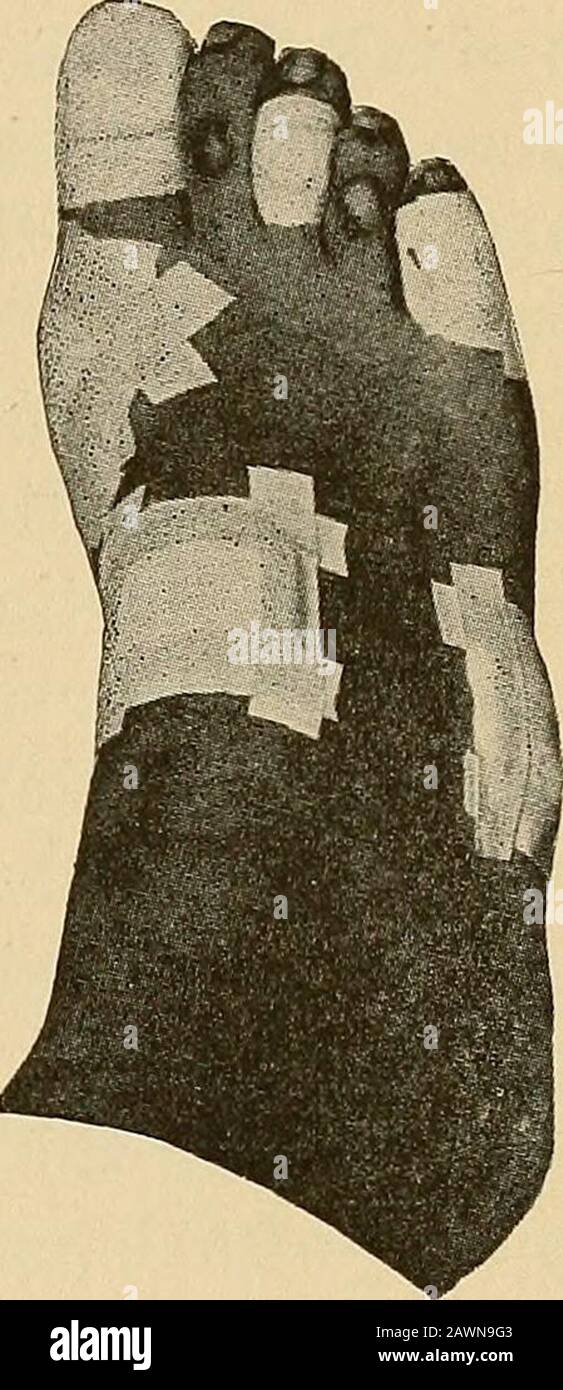 Practical podiatry : . DORSAL LINTDEESSING PLANTAR LINTDEESSING 68 ...