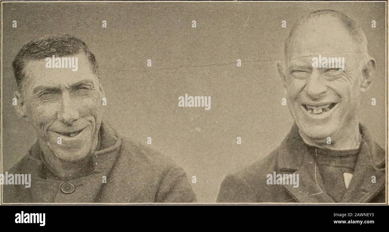 Microcephalic hi-res stock photography and images - Alamy