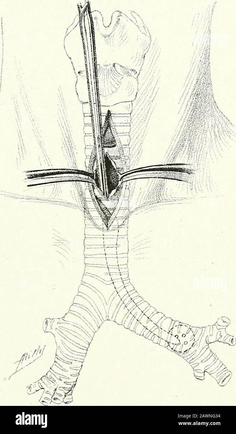Surgical therapeutics and operative technique . Fig. 369.—Direct ...