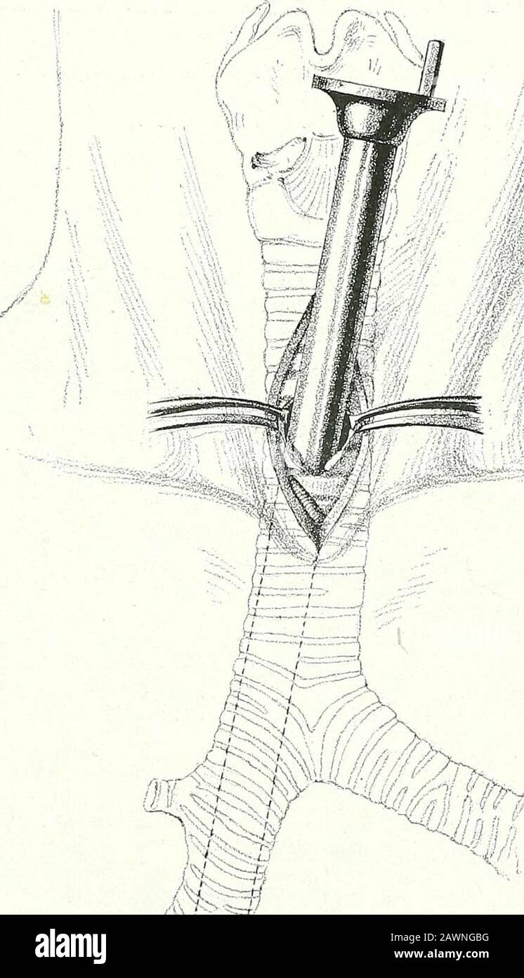 Surgical therapeutics and operative technique . Fig. 368.—Removal of a ...