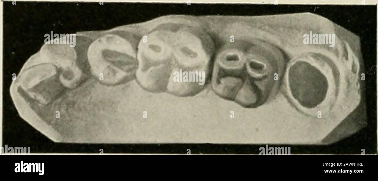 Gold inlays in teeth hi-res stock photography and images - Alamy