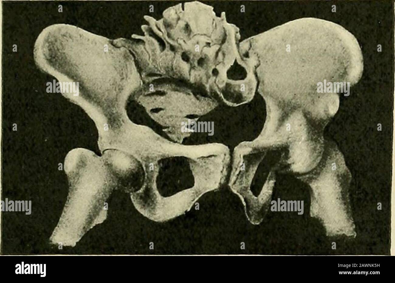 Pubiotomy hi-res stock photography and images - Alamy