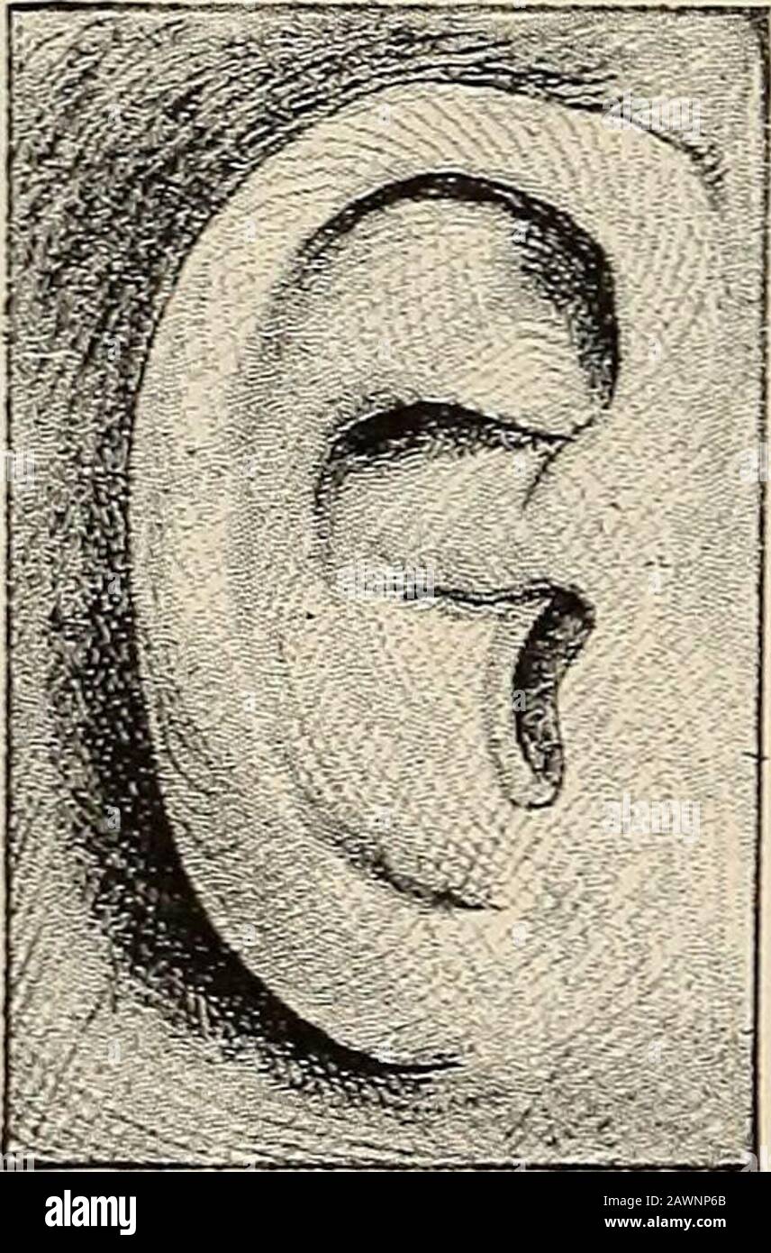 Nervous and mental diseases . Fig. 298.—No crus superius ;no anthelix ...