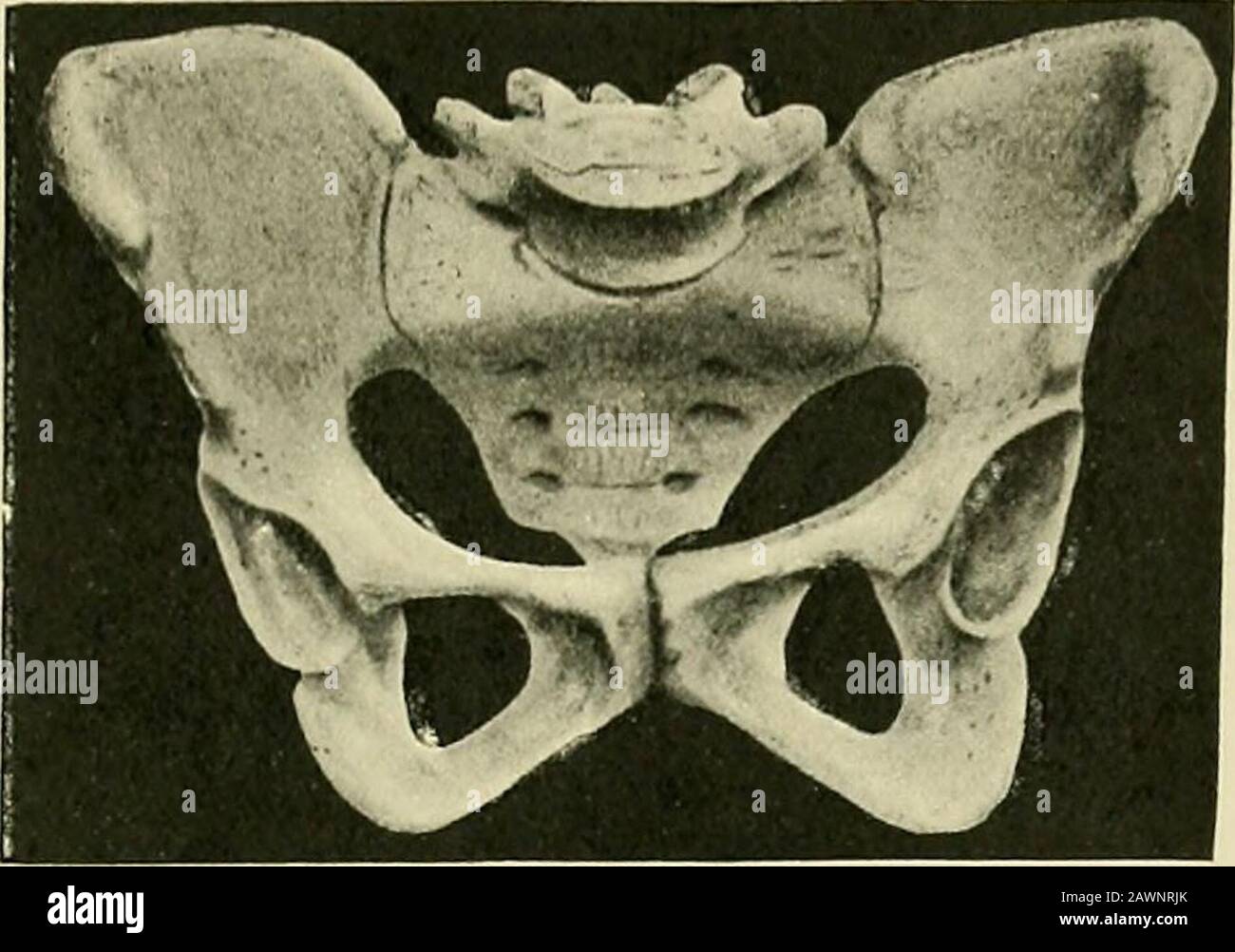 Rachitic Pelvis