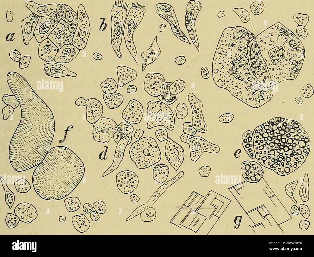 Sometimes in sputum hi-res stock photography and images - Alamy