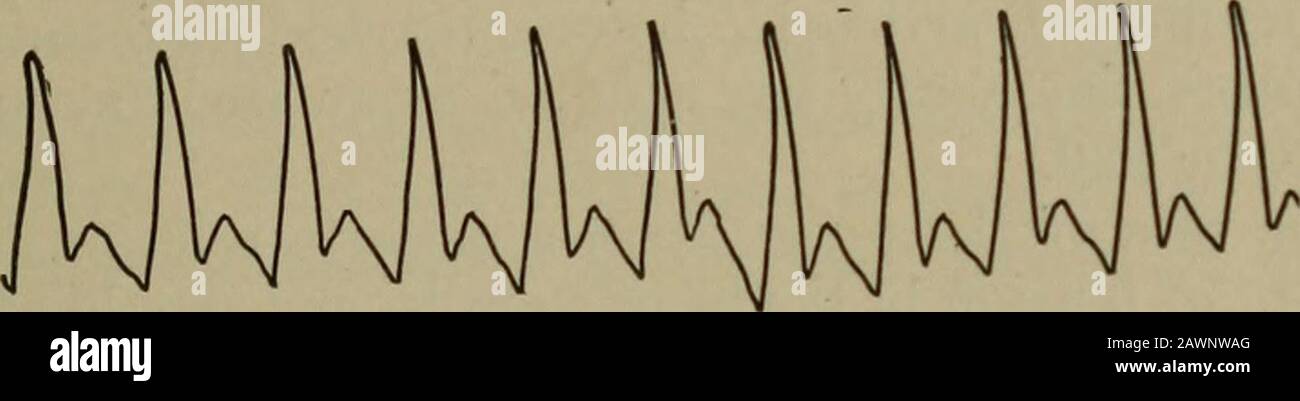 Physical diagnosis, including diseases of the thoracic and abdominal ...
