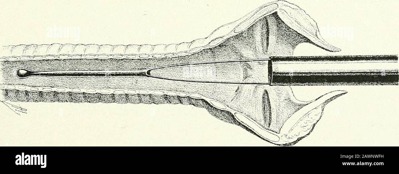Larynx scope hi-res stock photography and images - Alamy