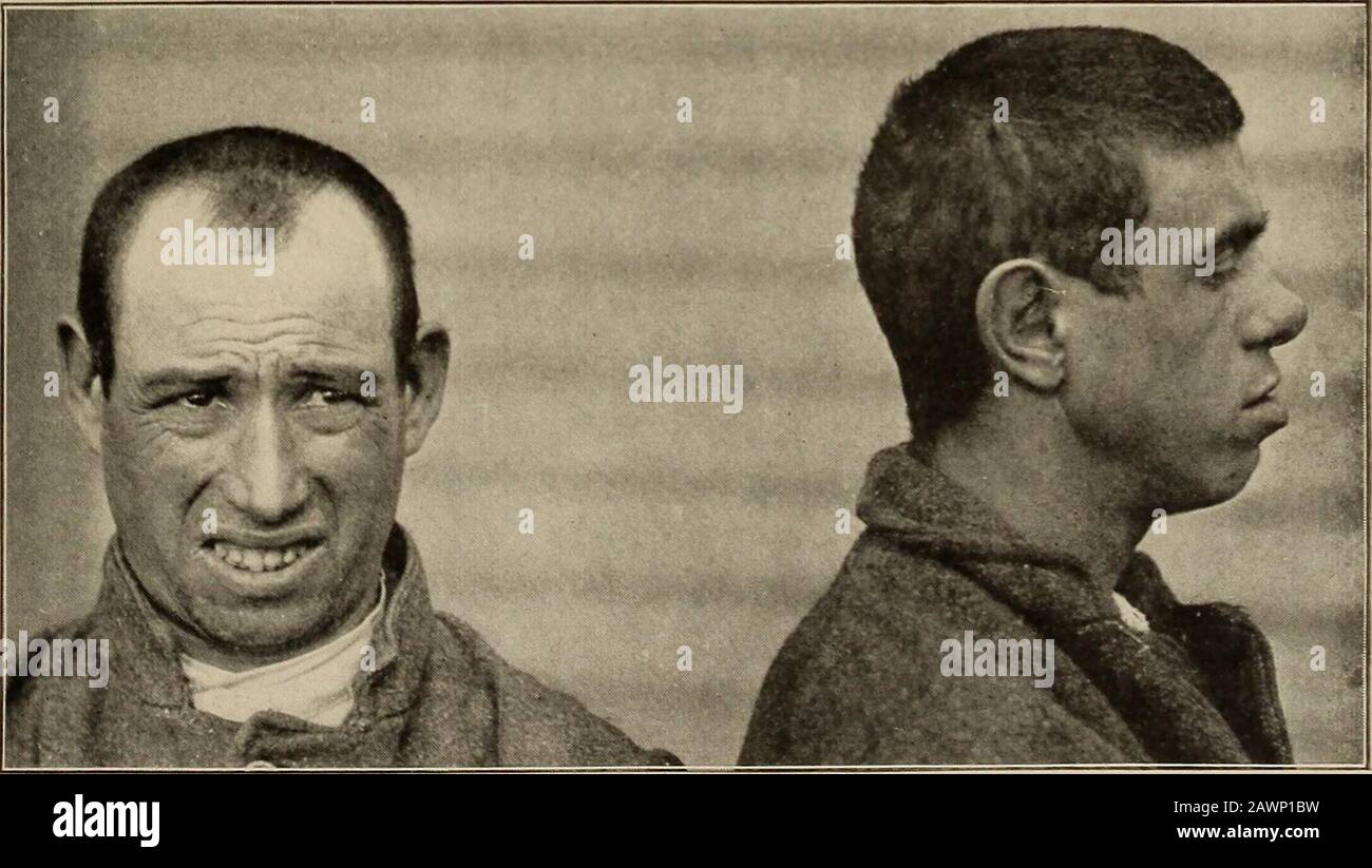 Microcephalic hi-res stock photography and images - Alamy