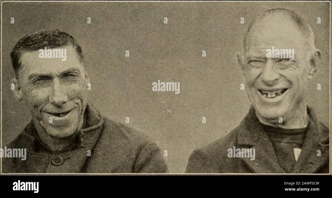 Microcephalic hi-res stock photography and images - Alamy