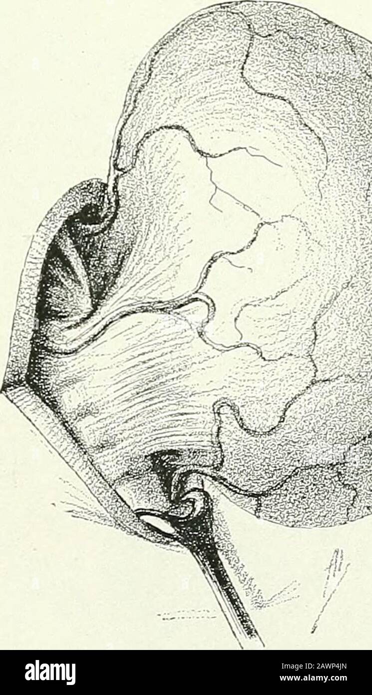 Surgical therapeutics and operative technique . Fig. 336.—Scheme of H ...