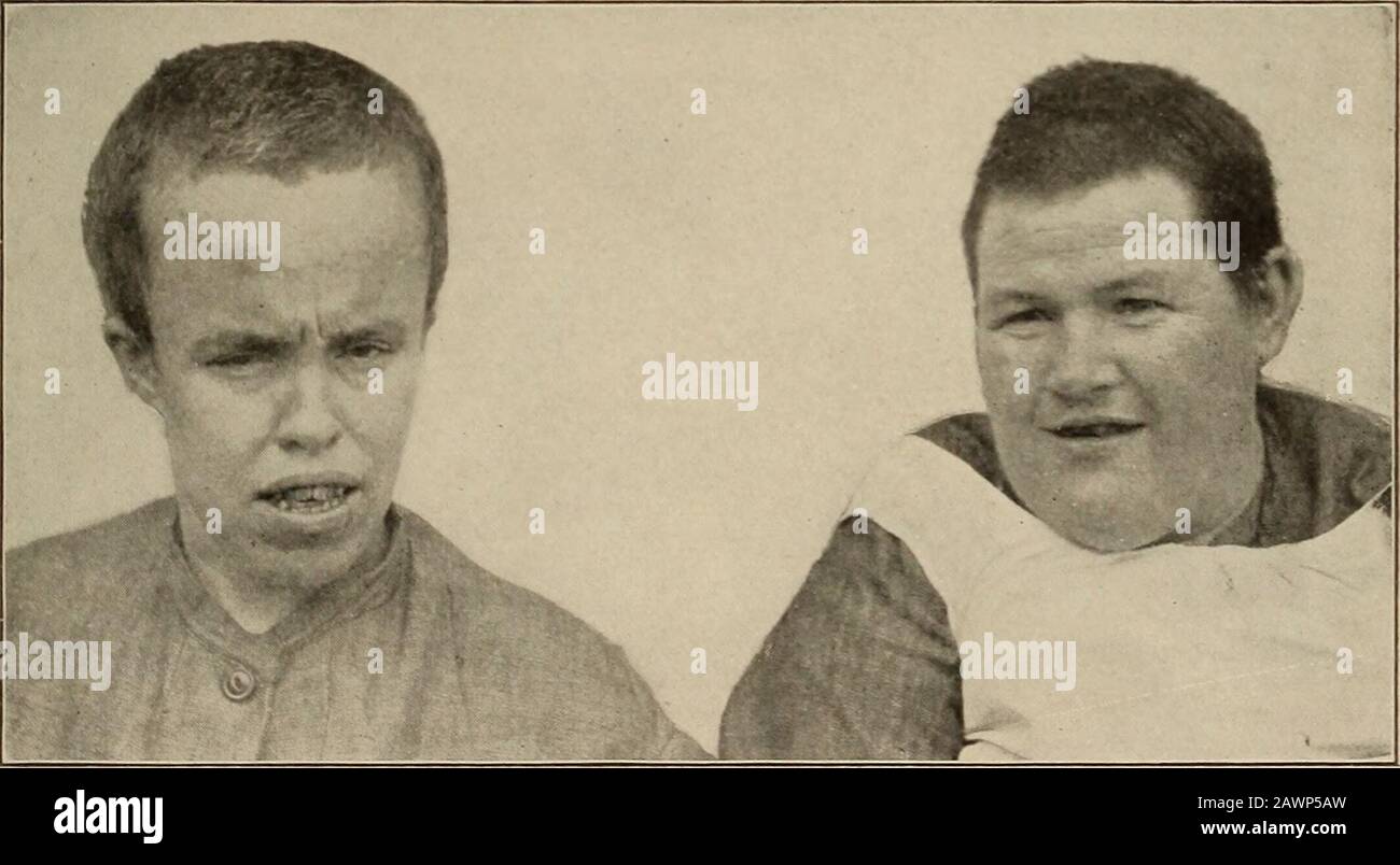 Nervous and mental diseases . Fig. 317.—Cretin aged thirteen years ...