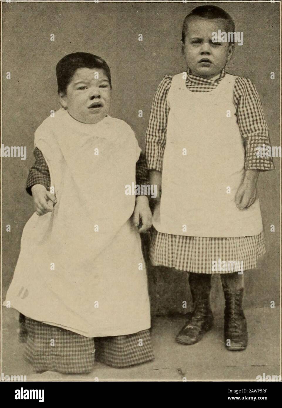 Nervous and mental diseases . Fig. 316 —Extreme hydrocephalic idiocy ...