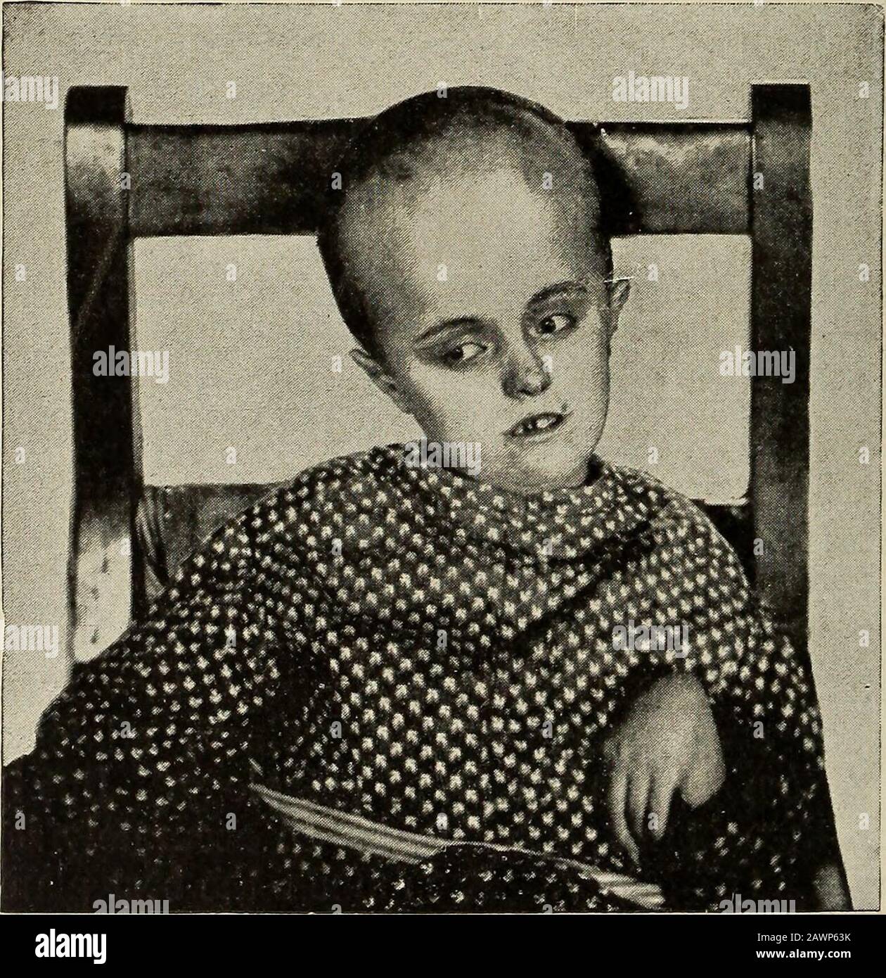 Hydrocephalic hi-res stock photography and images - Alamy