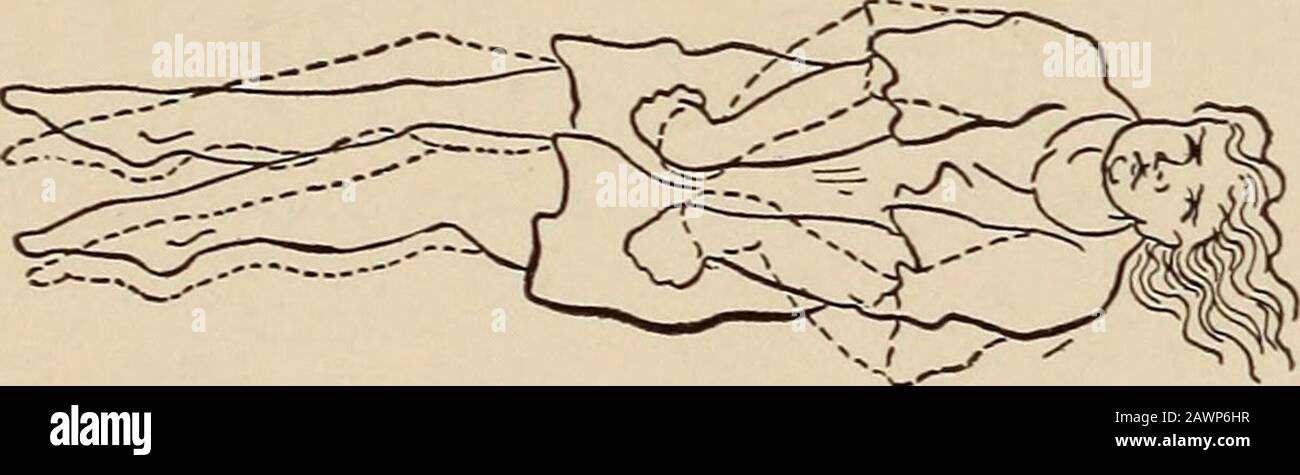 Nervous and mental diseases . Fig. 254.—Tonic phase, circumduction ...