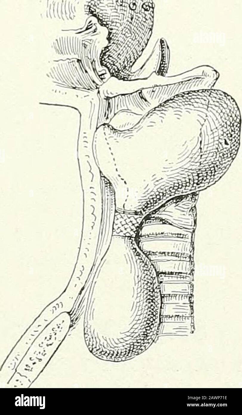 Surgical therapeutics and operative technique . Fig. 325. — Goitre de ...