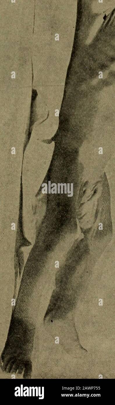 Physical diagnosis, including diseases of the thoracic and abdominal ...