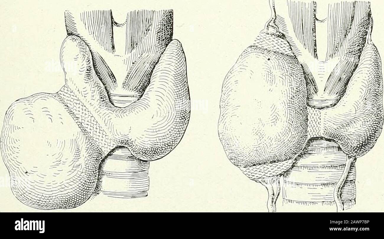 Goitres hi-res stock photography and images - Alamy