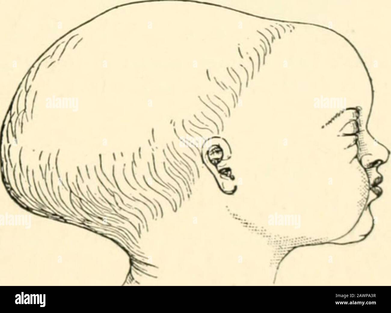 A textbook of obstetrics . Fig. 607. — Brow presentation(Schroeder ...